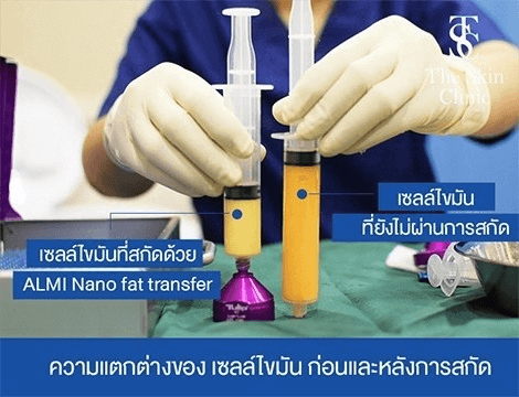 ALMI Nano fat transfer กระตุ้นรากผมด้วยเซลล์ไขมันตัวเอง